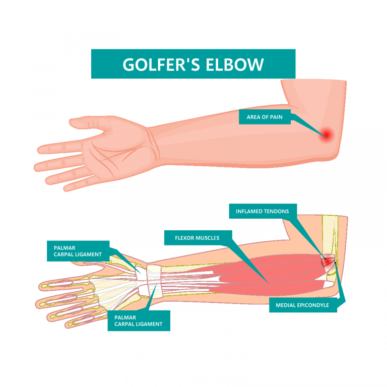 Golfers Elbow (Medial Epicondylitis) • Liz Tough Clinic