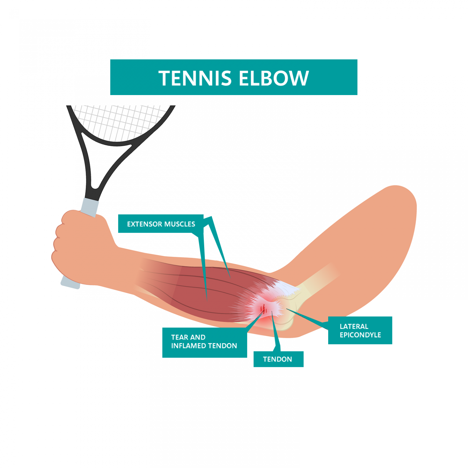 Tennis Elbow • Liz Tough Clinic